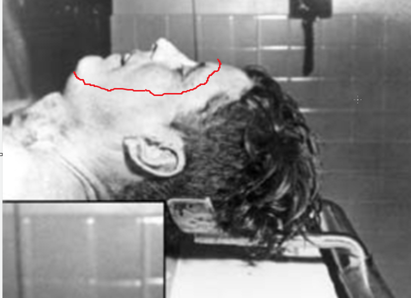 JFK autopsy photos – the final mile – Piece of Mindful